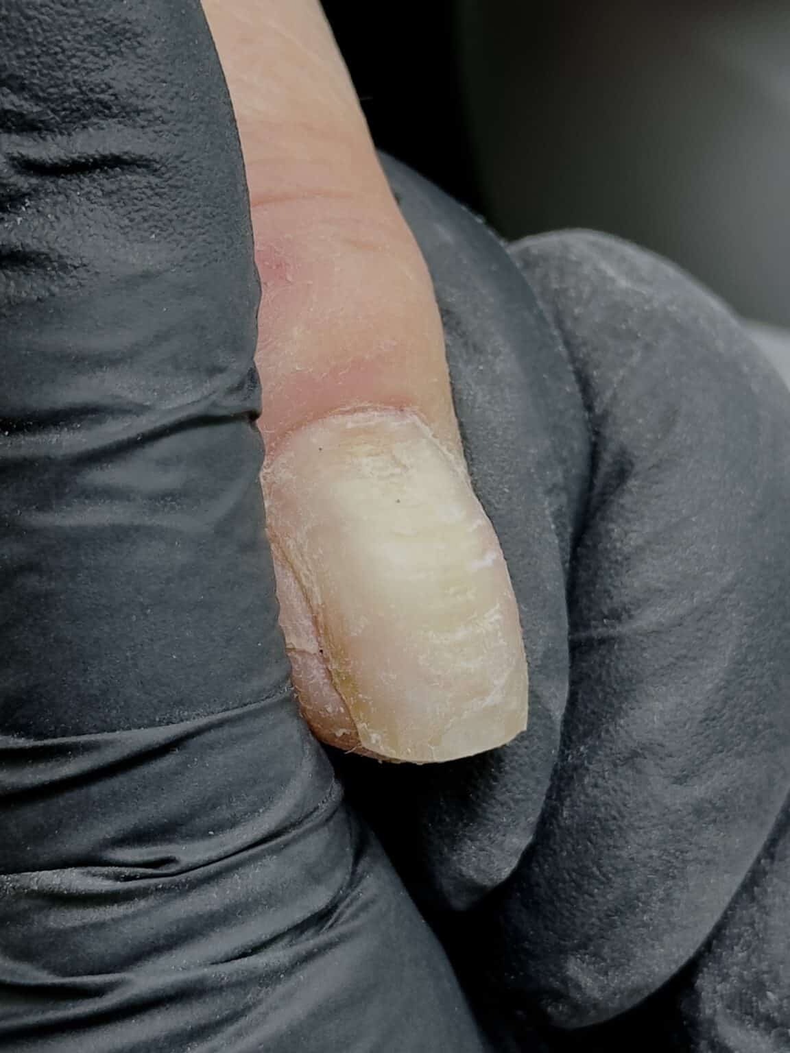 What is a nail habit-tic & can it be treated? - Scratch