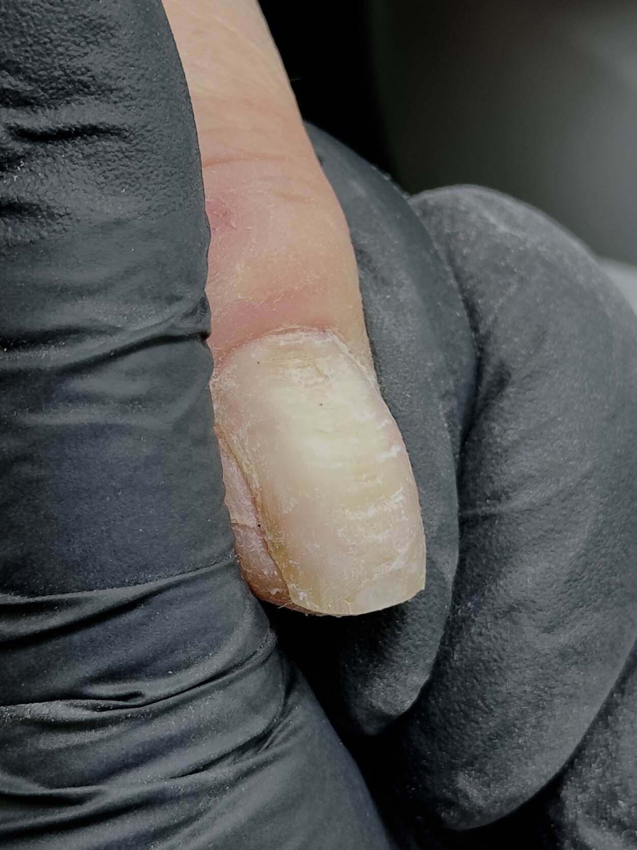 What is a nail habit-tic & can it be treated? - Scratch