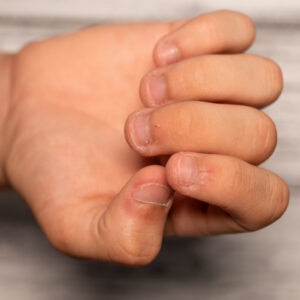 15 common nail conditions & how to deal with them - Scratch