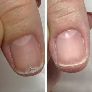 15 common nail conditions & how to deal with them - Scratch