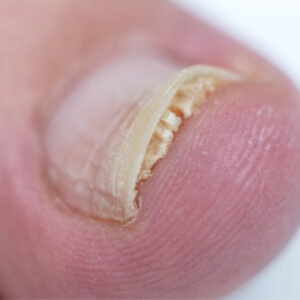 15 common nail conditions & how to deal with them – Scratch