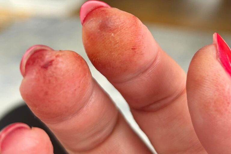 Nail techs, here’s the difference between irritant & allergic contact ...